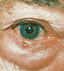 Eye Tumors and Eyelid Conditions - Florida Eye